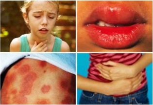 Anaphylaxis: A Life-Threatening Allergic Reaction | King County Medic ...